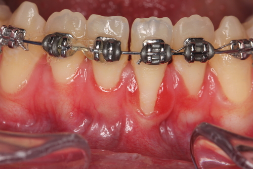 ¿QUÉ ES UNA RECESIÓN GINGIVAL? - Health & Smile